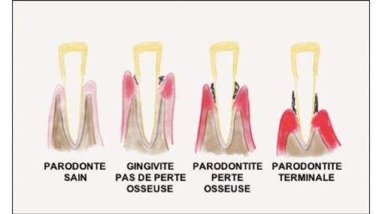 Parodontite : traitement - Cabinet Parodontie Paris 11 - Docteur Chevalier