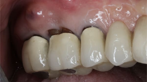 Parodontite : symptômes - Cabinet Parodontie Paris 11 - Docteur Chevalier