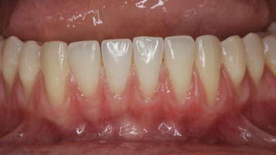 classe 1 cairo classification recession parodontale dr chevalier dr ...